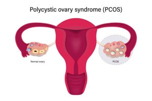 What is PCOS Belly? How PCOS Belly Affects Your Life